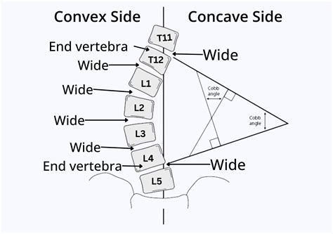 Scoliosis Spinedrx