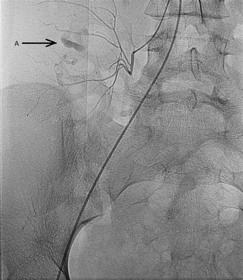 Super Selective Superior Mesenteric Artery Angiogram Using
