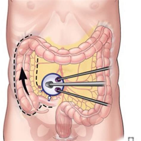 Dissection Is Proceeded To The Rectosigmoid Junction Download Scientific Diagram