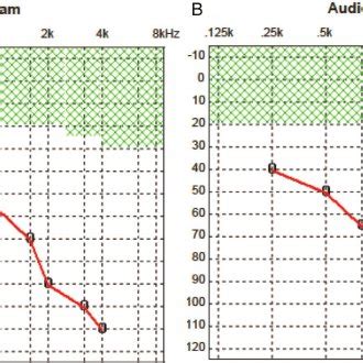 Speech Test Results In Quiet And In Noise Download Table