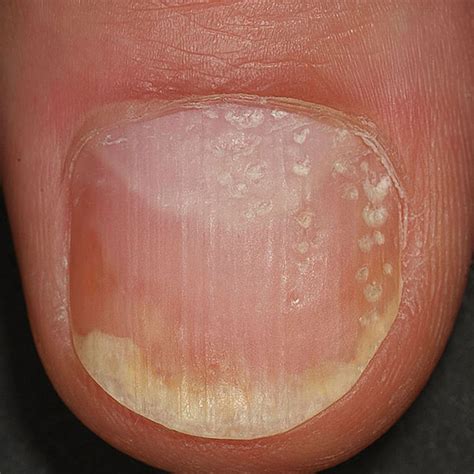 Are You Seeing Holes And Dents In Nails Read This