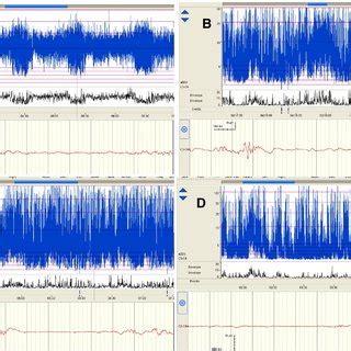 AEEG Characteristics Across Gestational And Post Conceptional Age Based Download Scientific