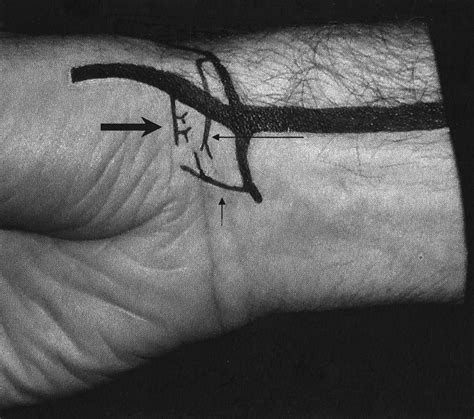 Arterial Supply Of The Scaphoid Volar Surface The Lateral Volar