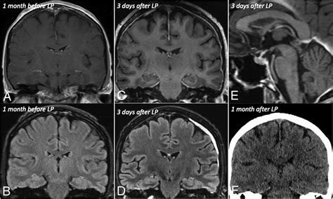 Lumbar Puncture Findings Clinical Review Of The Clinical Necessity Of