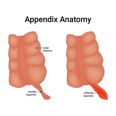 Premium Vector Appendix Anatomy Large Intestine Healthy Appendix Inflamed Appendix Vector