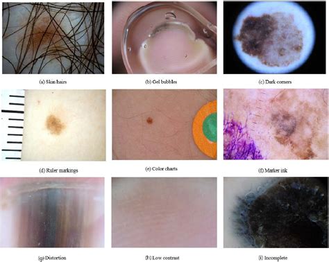 Figure 1 From Recent Advances In Diagnosis Of Skin Lesions Using Dermoscopic Images Based On