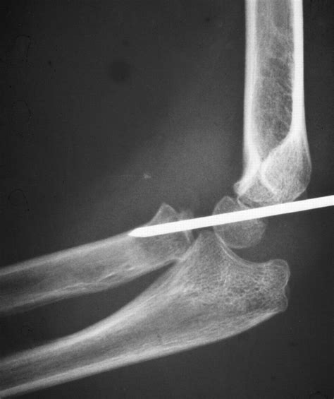 Open Reduction Ulnar Osteotomy And External Fixation For Chronic Anterior Dislocation Of The