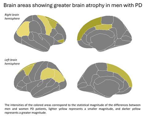 Parkinsons Disease Impacts The Brain Differently Depending On Sex