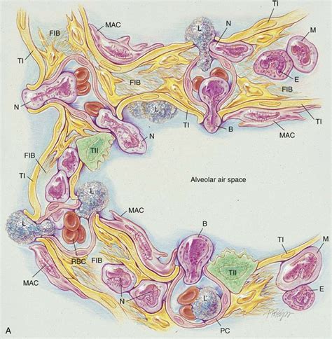 Interstitial Lung Diseases Thoracic Key