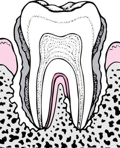 Imageperiodontitis From Plaque To Tooth Loss Merck Manual Consumer