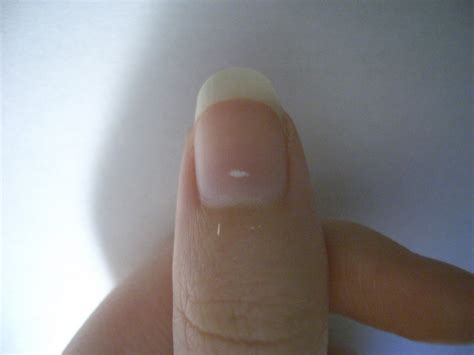 White Spots Under Fingernails