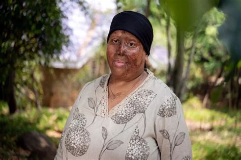 Pragya Prasun Singh एसिड पीड़िता प्रज्ञा सिंह शाहरुख खान से मांगी मदद