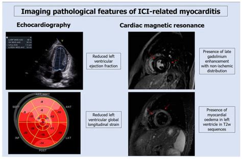 Immune Checkpoint Inhibitors Associated Myocarditis Diagnosis