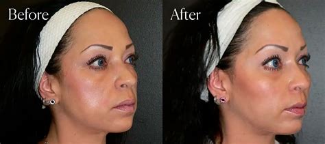 Cheek Implant Before And After Denver Co Shah Aesthetic Surgery