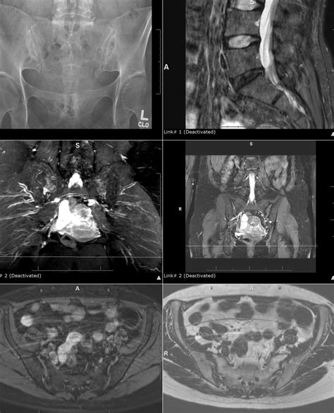 CPPD Crown Dens Syndrome OCAD