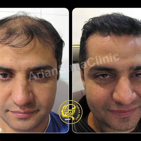 کاشت مو کلینیک تخصصی پوست و موی آرین سیما