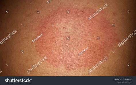 Tinea Pedis Ringworm Infection Body Back ภาพสต็อก 2305755889 Shutterstock