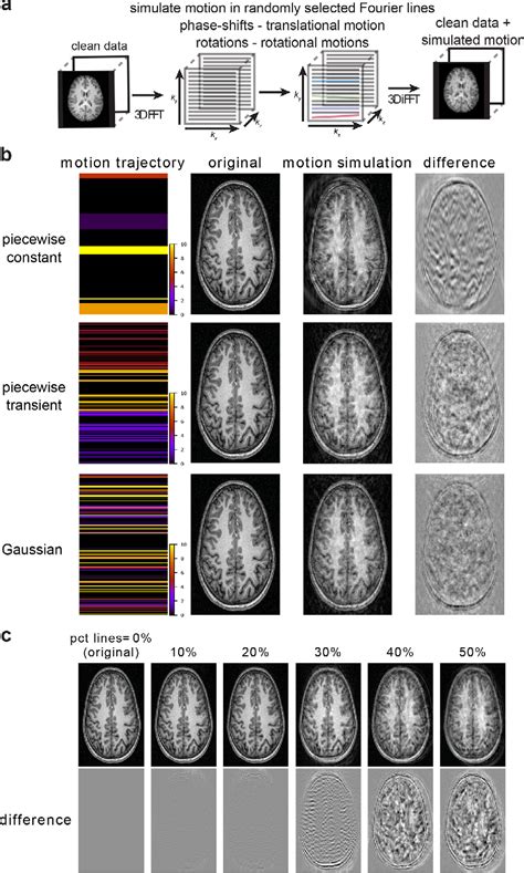 Figure 2 From Retrospective Motion Artifact Correction Of Structural