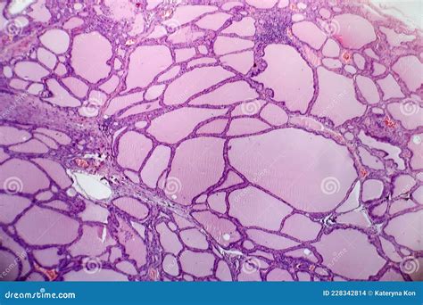 Multinodular Goiter Histology