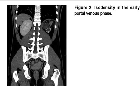 Figure 1 From What Is A Reliable Ct Scan For Diagnosing Splenosis Under