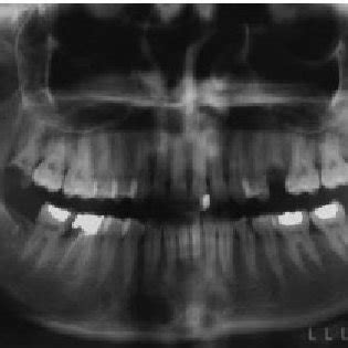 A Diagrammatic Illustration Of A Panoramic Radiograph With The Arrows