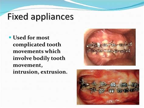 Management Of Class Ii Division 1 Malocclusion
