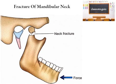 Mandible Osteology Anatomy Notes Class Notes
