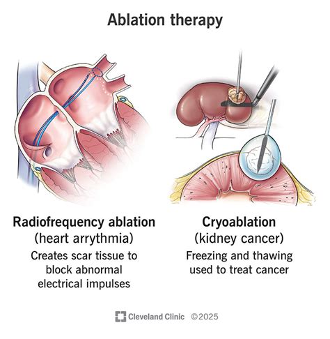 Ablation Therapy Procedure Details