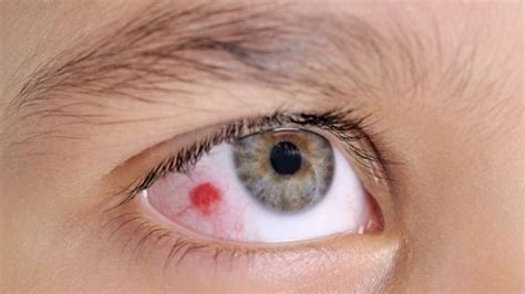 انتبه البقع الحمراء في العين مؤشر للإصابة بـ مرض خطير