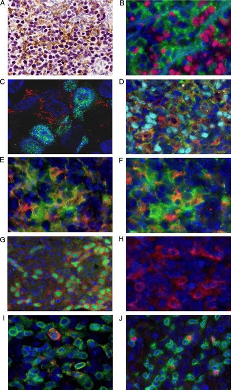 Pd L1 Expression And Microenvironment Analysis Using Ihc If And