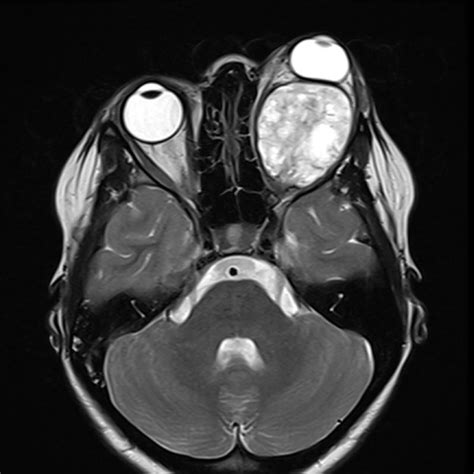 Abdulnaser A Q Salih On Linkedin Optic Pathway Glioma