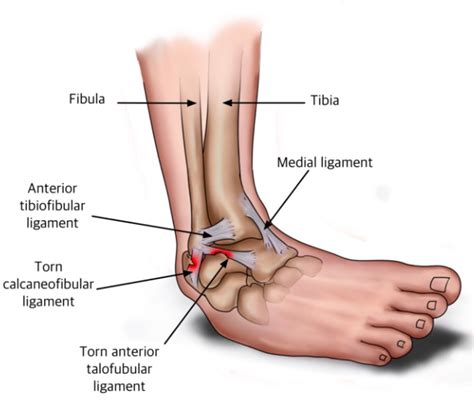 Ankle Inversion Vs Eversion Pem Source