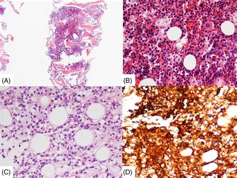 A Bone Marrow Biopsy Hypercellularity 90 Hande Stain ×20 B Bone Download Scientific