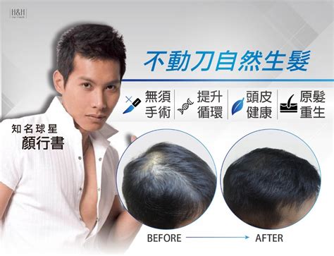 禿頭前兆有哪些？髮旋禿怎麼辦？禿頭 髮旋禿原因、治療與症狀指南