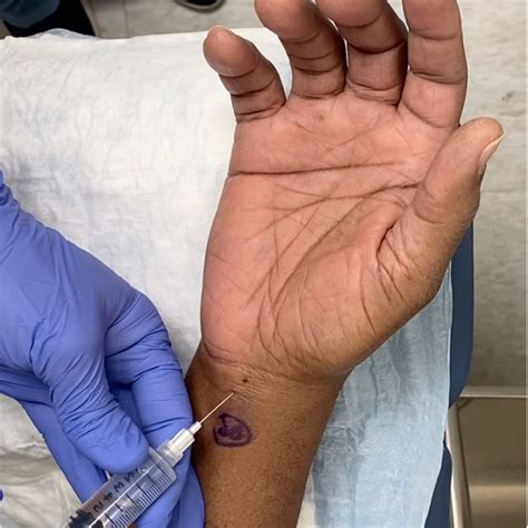 The Location Of The Local Anesthetic Injections Administer Local