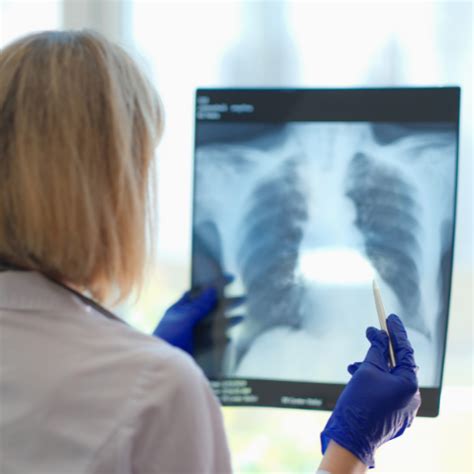 Types Of Silicosis Chronic Accelerated And Acute Ssc Stone Silicosis Center