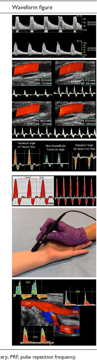 [pdf] Interpretation Of Peripheral Arterial And Venous Doppler Waveforms A Consensus Statement
