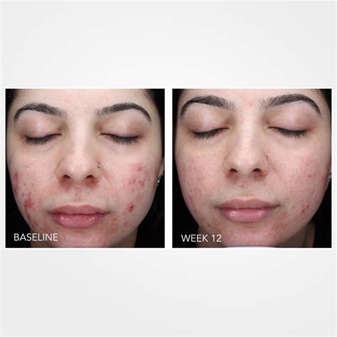 Zo Skin Health Acne Complex 50ml