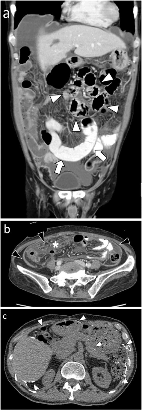 Imaging Pearls And Differential Diagnosis Of Encapsulating Peritoneal Sclerosis Emphasis On