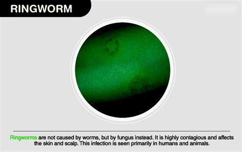 Understanding Ringworm Causes Symptoms Types And Treatment