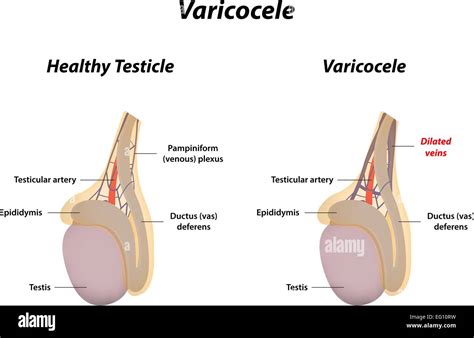 Varicocele Ultrasound Criteria