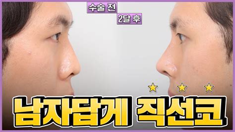 남자코성형 남자 코라인의 중요성 남자다운 직선코라인 성형리뷰 에이비성형외과 Youtube