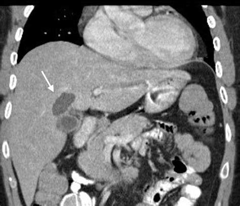 Computed Tomography Image Showing An Intrahepatic Cyst Arrow Download Scientific Diagram