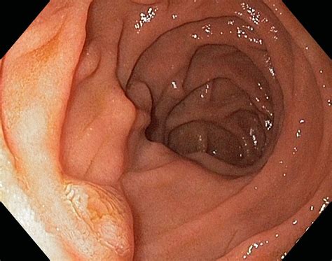 Normal Endoscopy Results