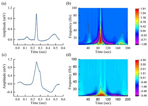 automatic ecg classification using continuous wavelet transform and