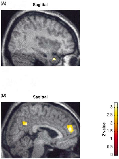 A Statistical Parametric Map Spm Showing The Anterior Cingulate And