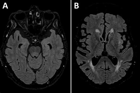 Encephalitis Mri