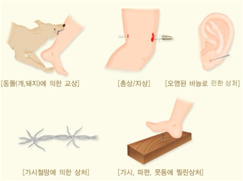 파상풍 예방접종 주사 가격 병원 파상풍 초기증상과 치료 네이버 블로그