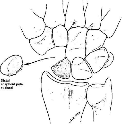 Figure 6 From Proximal Row Carpectomy Semantic Scholar