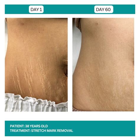 Stretch Mark Removal Stadia Med Spa